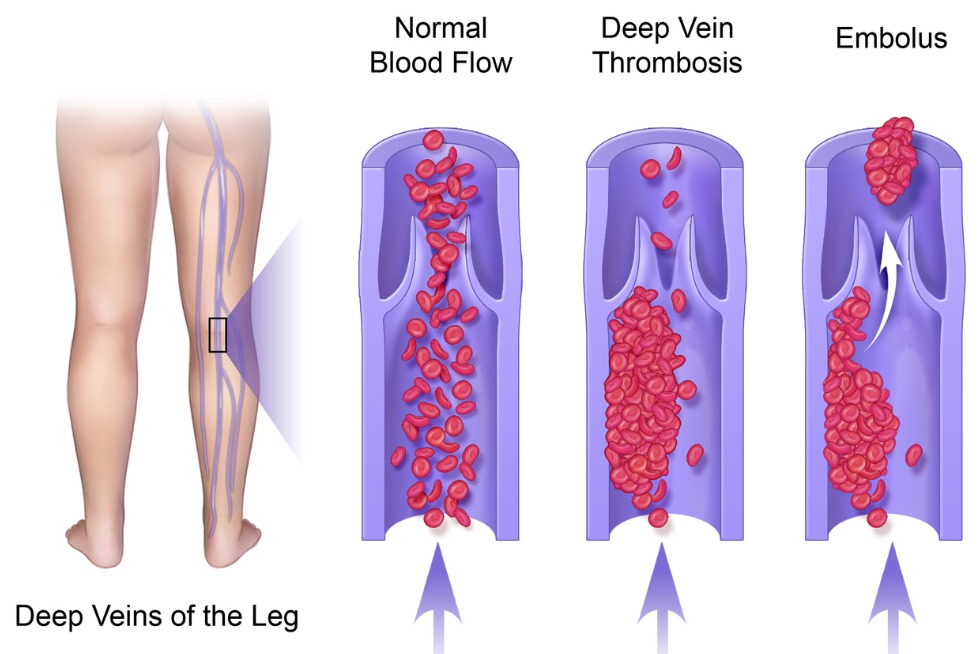 Course - Venous Thromboembolism (VTE)